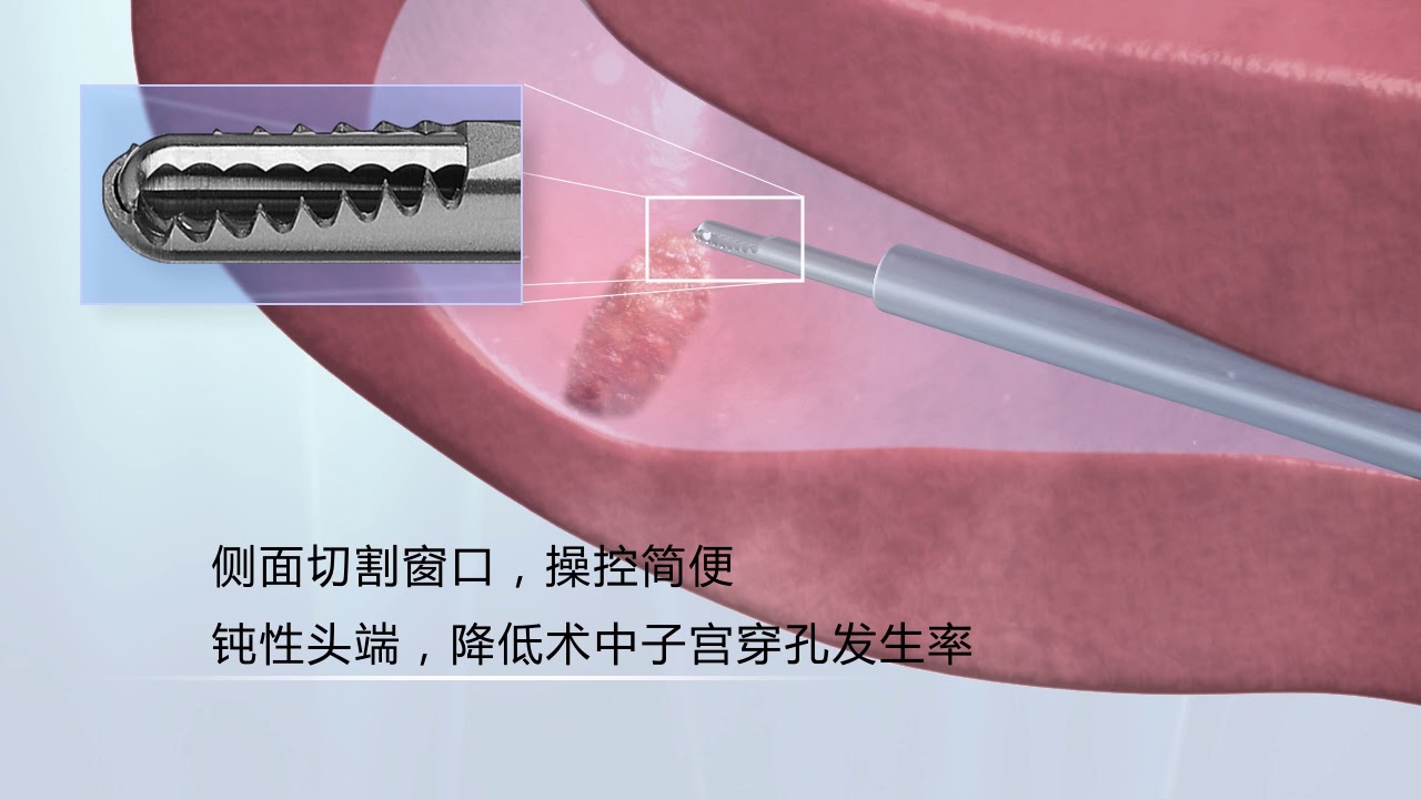 Laparoscopic Videos – Chua Obgyn and MIS